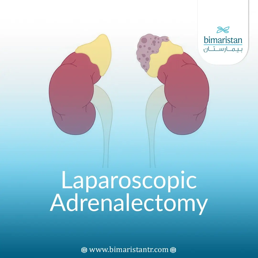 Laparoscopic adrenalectomy in Turkey- بيمارستان