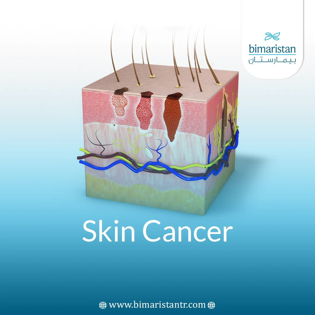 Skin Cancers: Causes, Symptoms & Effective Treatment Guide