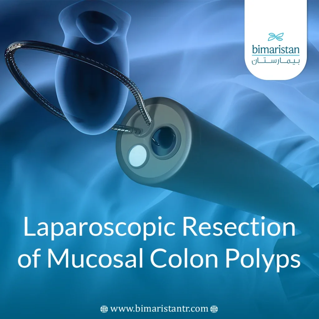 Laparoscopic Removal of Mucosal Colon Polyps in Turkey