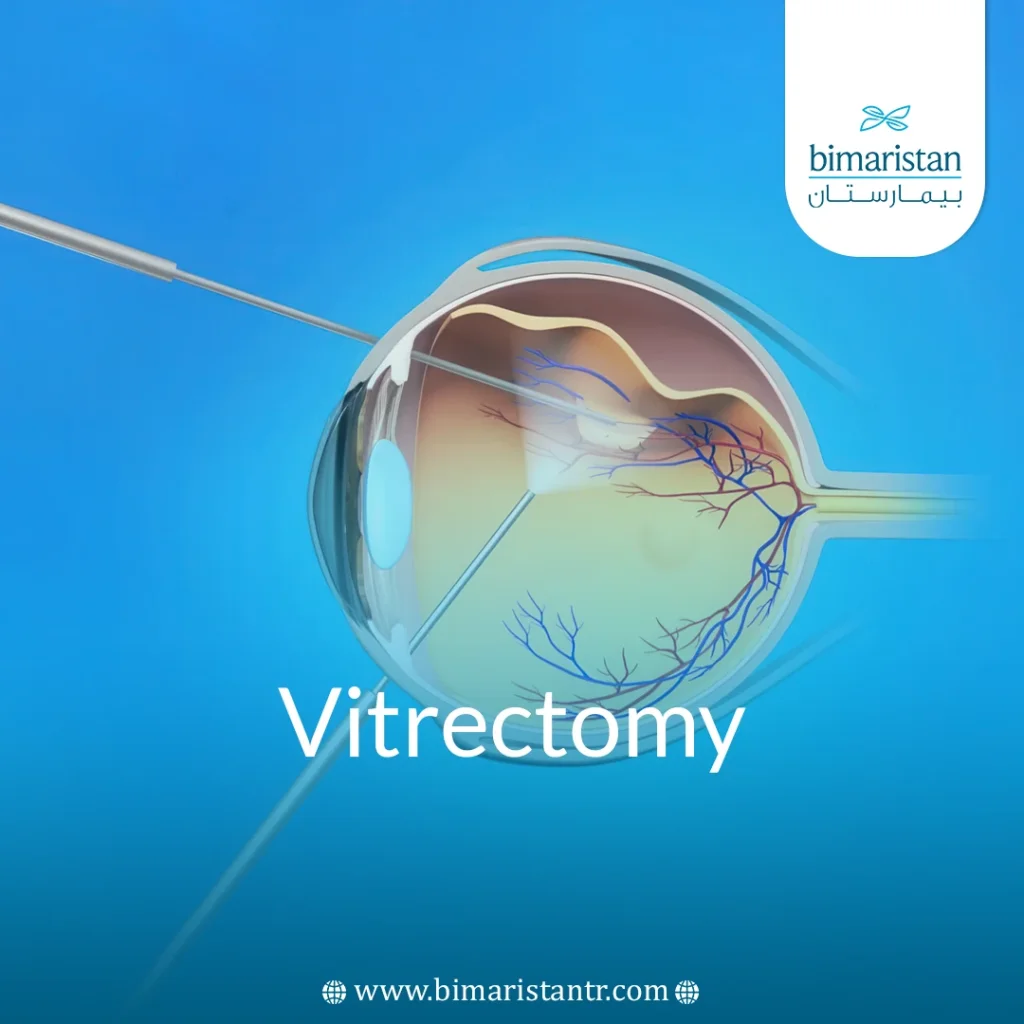 Vitrectomy in Türkiye: Procedure and Risks 2025 - Bimaristan