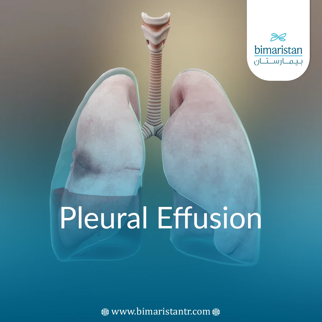 Pleural Effusion: Types and Treatment Options - Bimaristan
