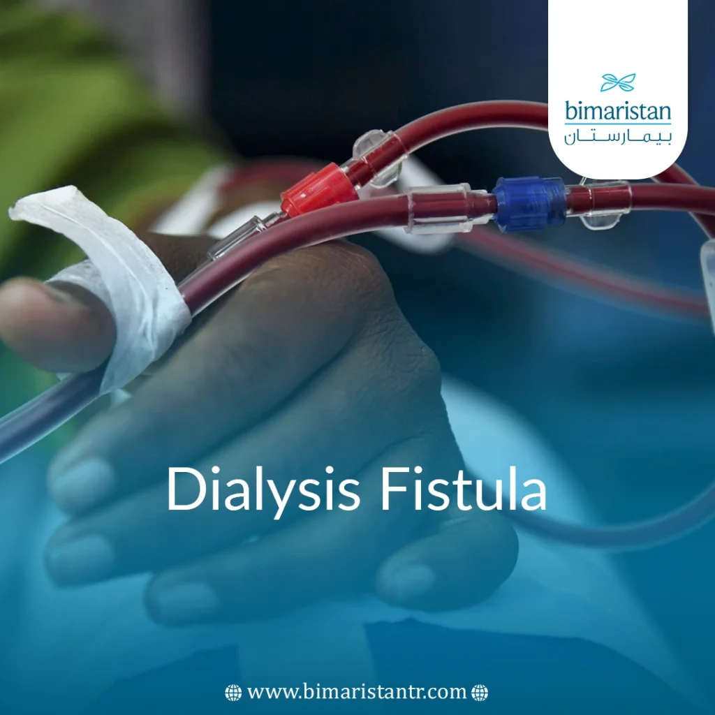 Dialysis Fistula in Turkey | Arteriovenous Shunt Explained