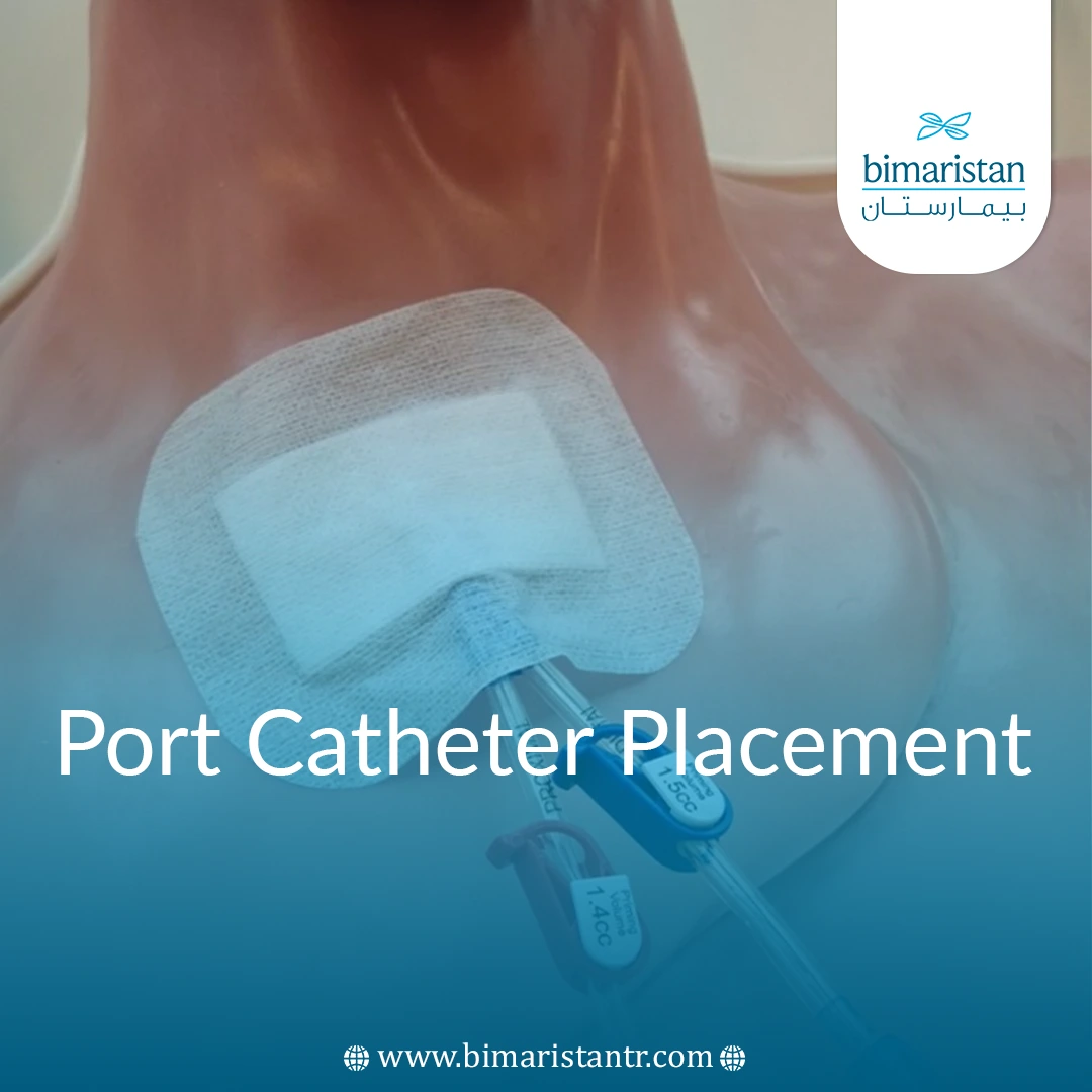 Port Catheter Placement: Central Venous Access in Turkey