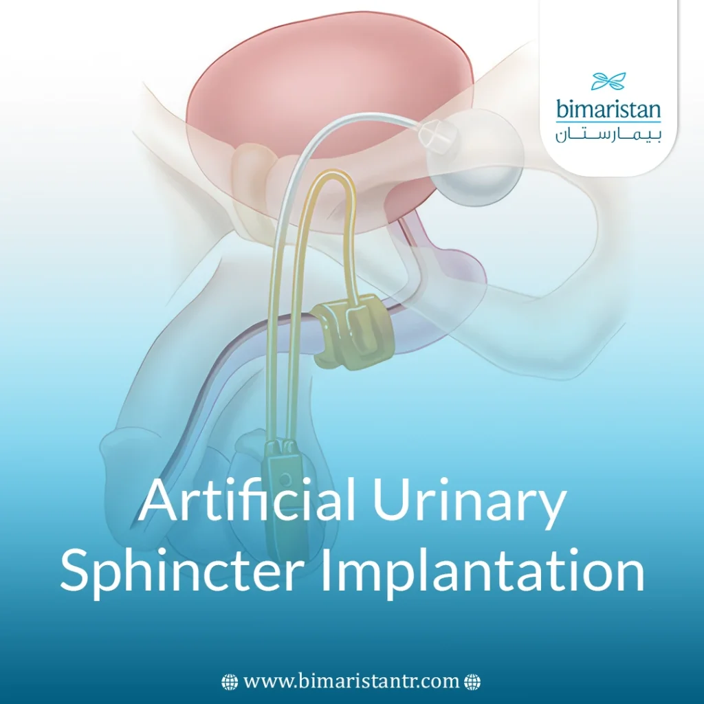 Artificial Urinary Sphincter Implantation in Turkey - بيمارستان