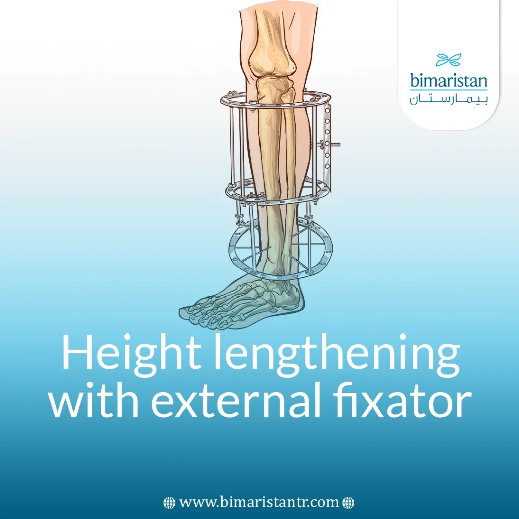 Limb Lengthening With External Fixator: Steps and Results