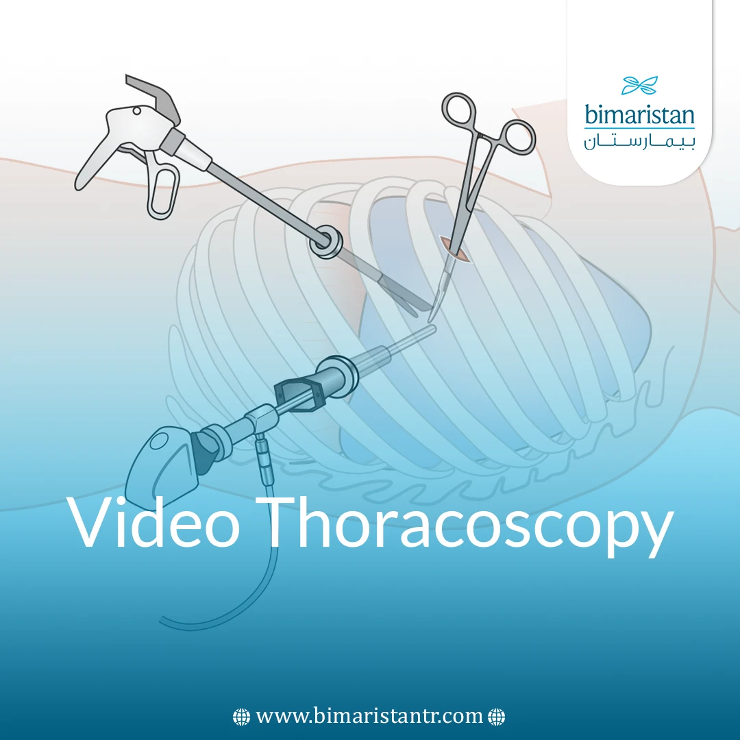 Video Thoracoscopy in Turkey: Essential Guide - Bimaristan