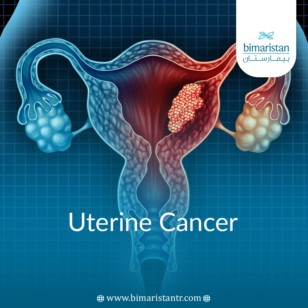 Uterine cancer symptoms, diagnosis and treatment in Turkey بيمارستان