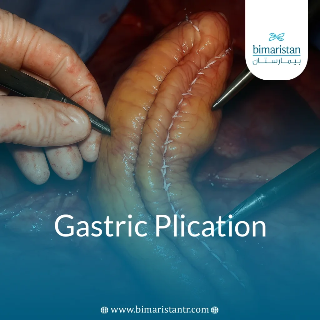 Gastric Plication Surgery - Bimaristan