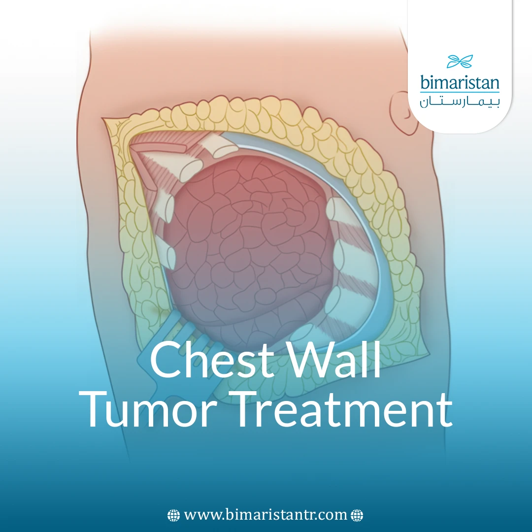 Treatment of chest wall tumors between surgery and rehabilitation ...
