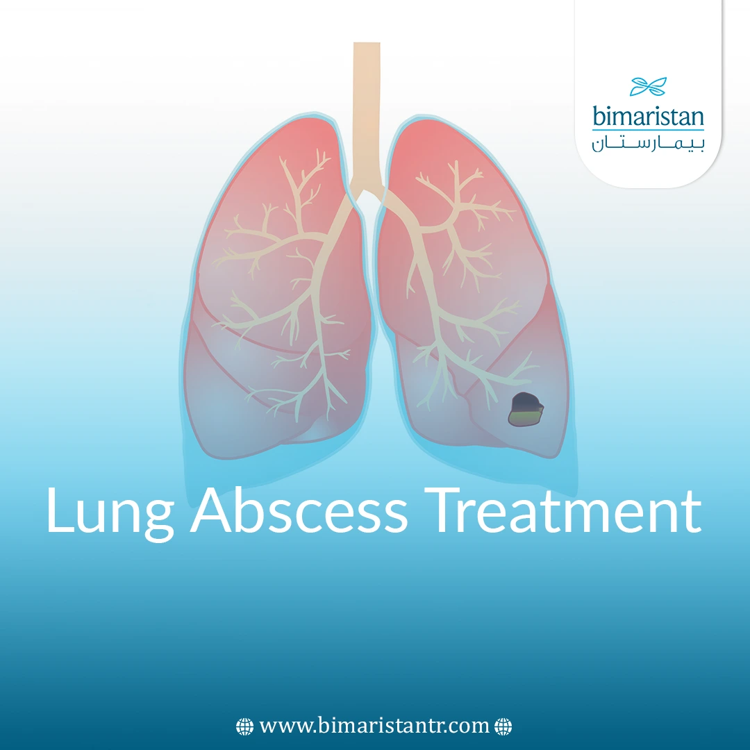 Lung Abscess Treatment: Removal & Prevention - Bimaristan