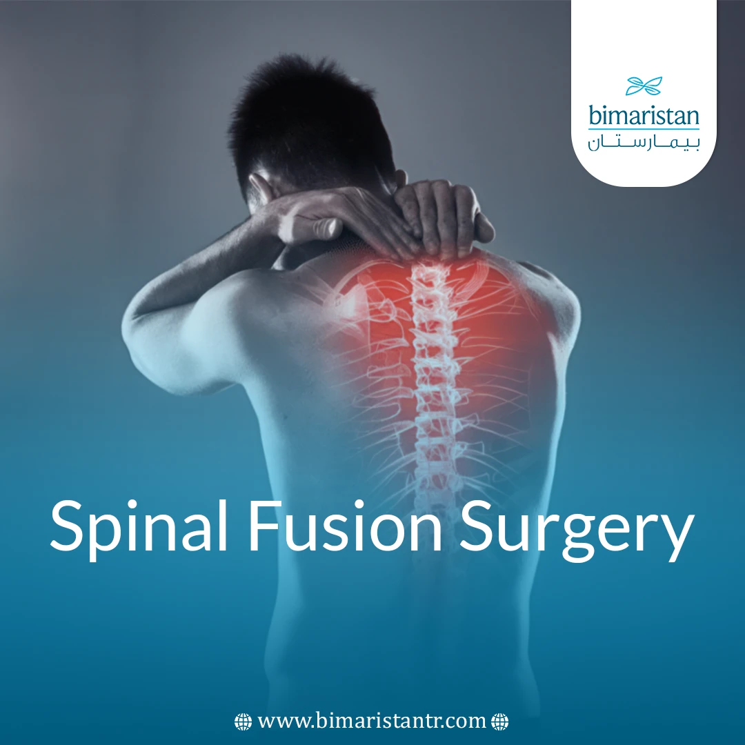 Spinal Fusion Surgery: Benefits and Procedure - Bimaristan