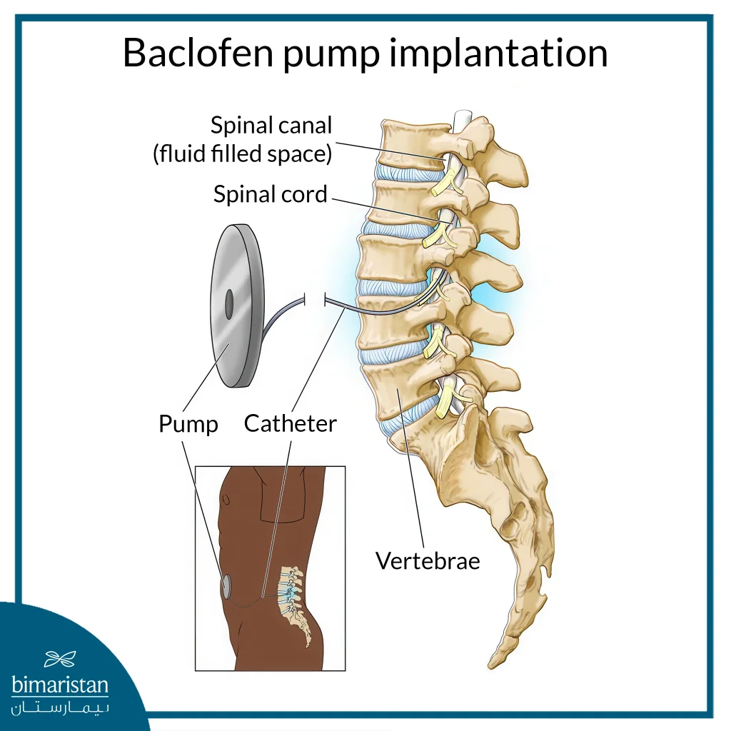 Baclofen Pump Implantation: Effective Treatment for Spasms