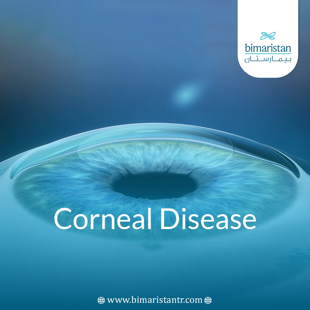 Corneal Disease: Common Types, Treatment, & Prevention Tips