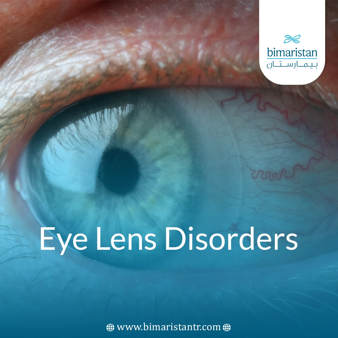 Eye Lens Disorders: Risks and Solutions - Bimaristan