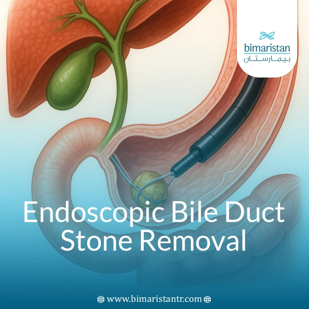 Endoscopic Bile Duct Stone Removal: Complete Medical Guide
