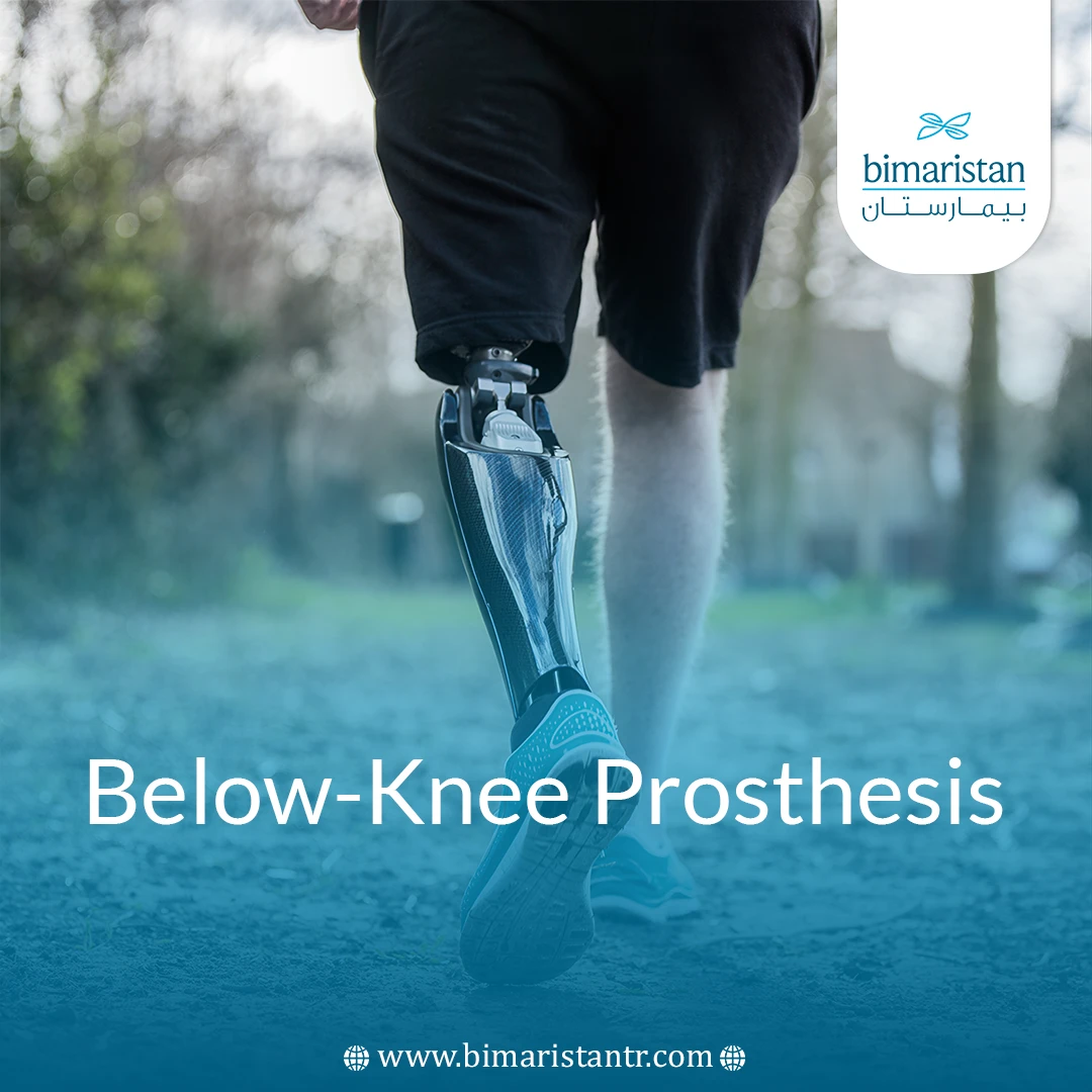 Below-Knee Prosthesis: Types, Parts & How to Choose