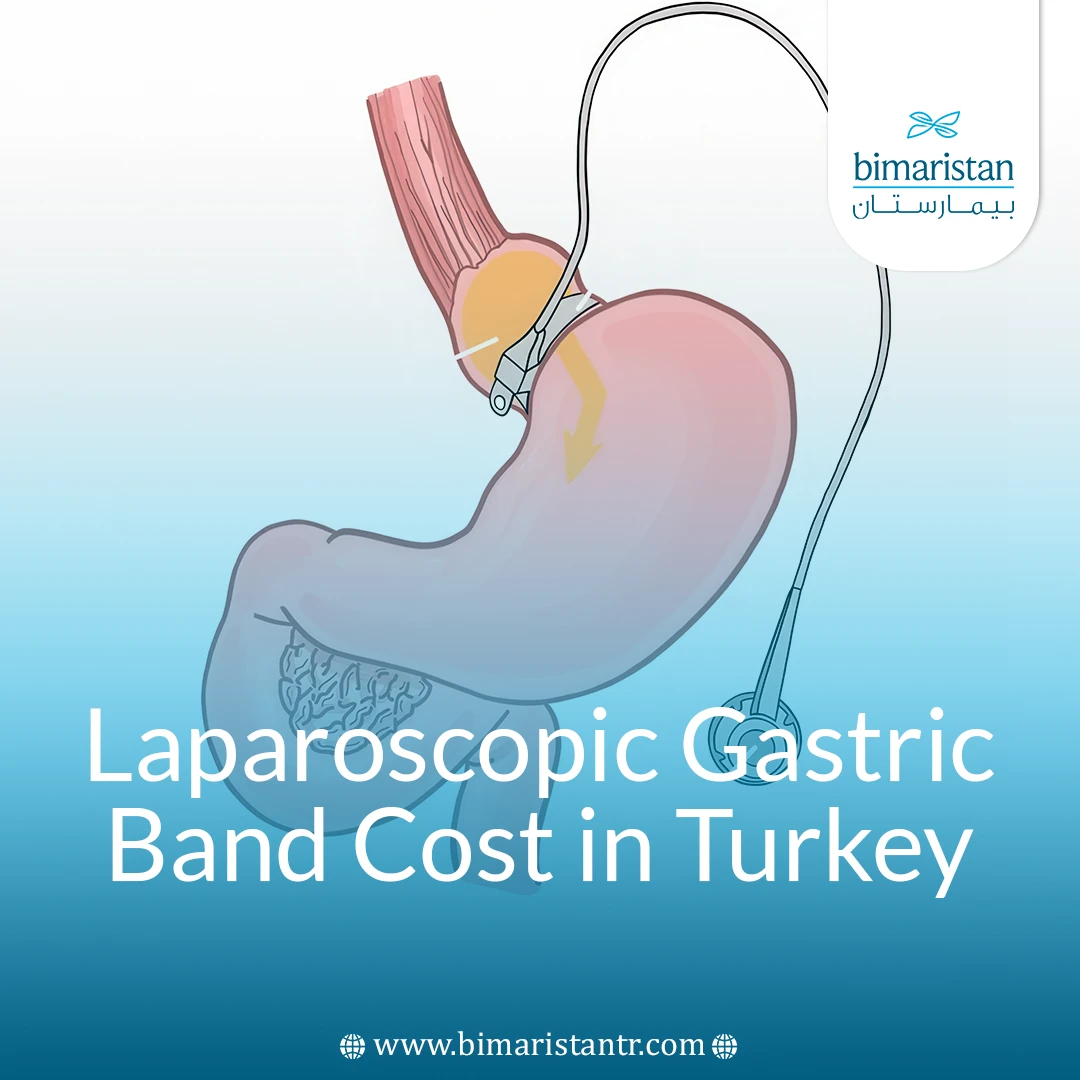 Laparoscopic Gastric Banding Cost in Turkey - Bimaristan