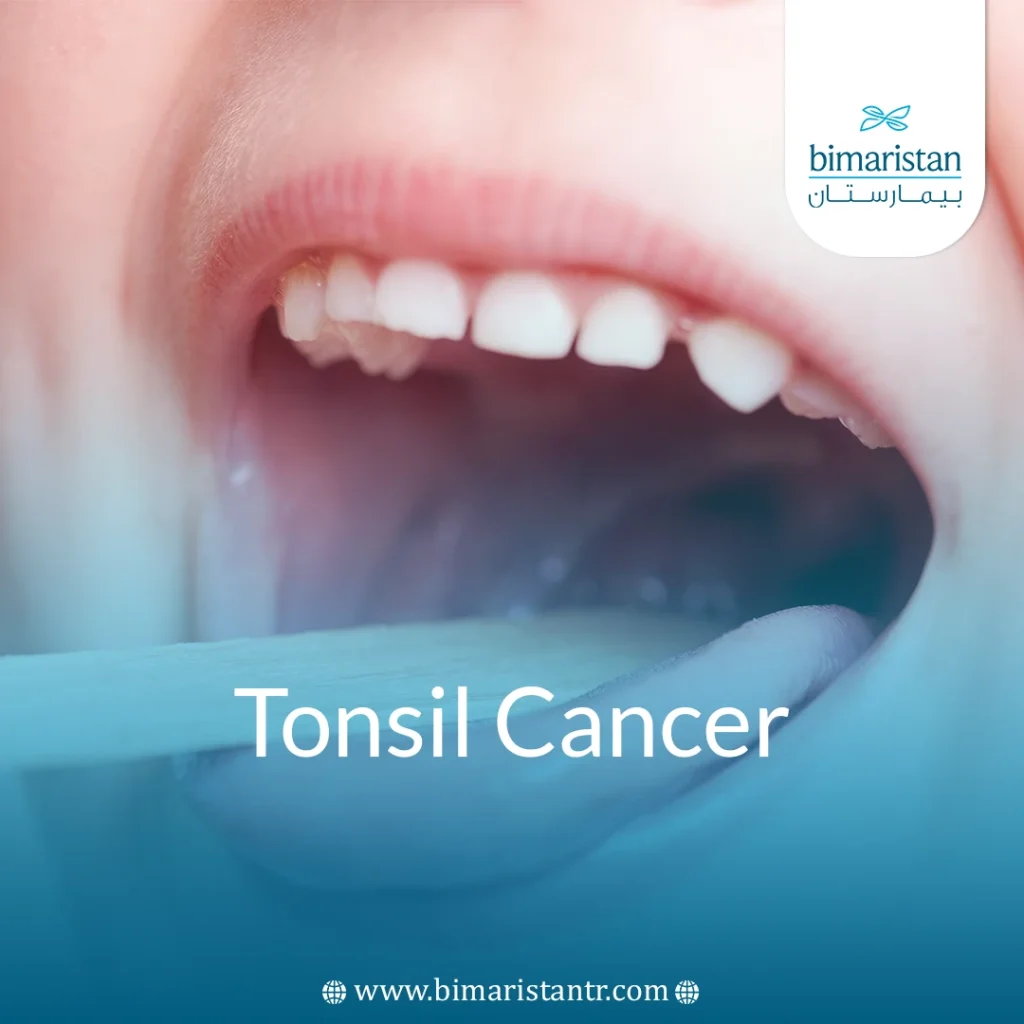 Tonsil Cancer: Symptoms & Advanced Treatment Options Turkey