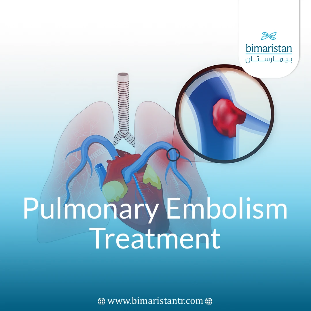 Pulmonary Embolism Treatment: Symptoms and Prevention Tips