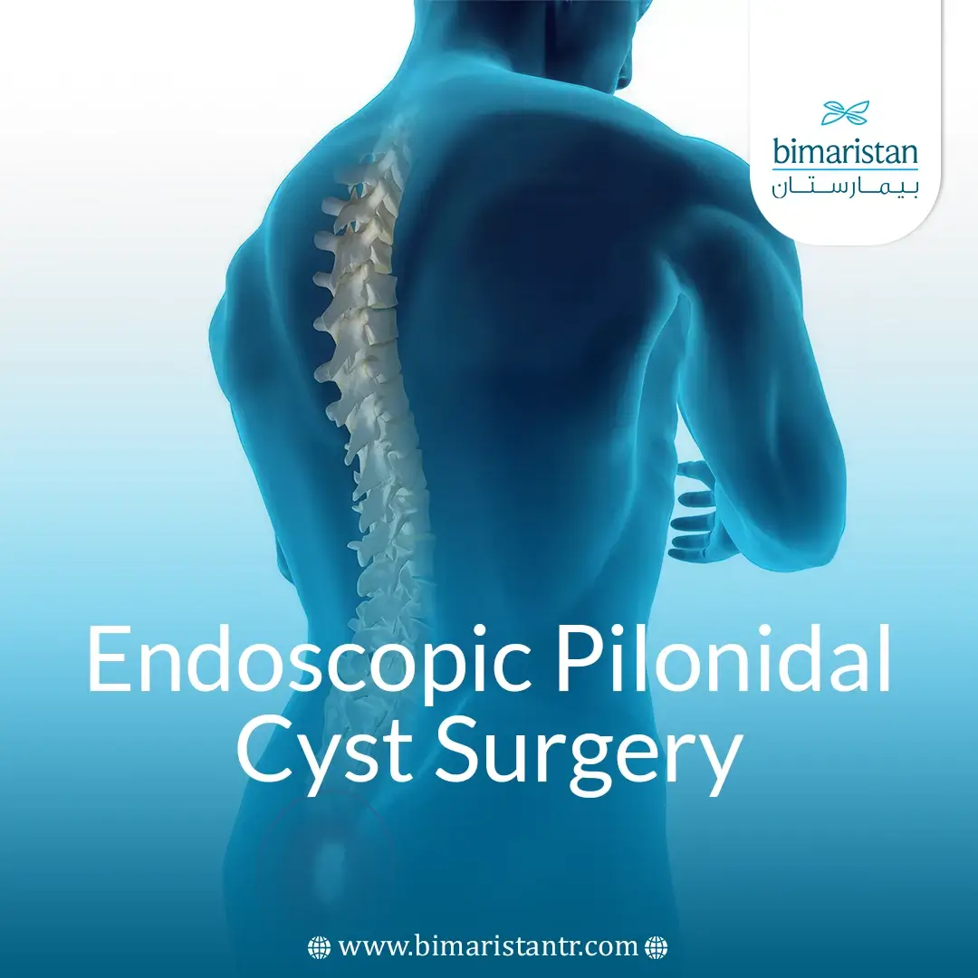 Endoscopic Pilonidal Cyst Surgery: Painless Modern Solution