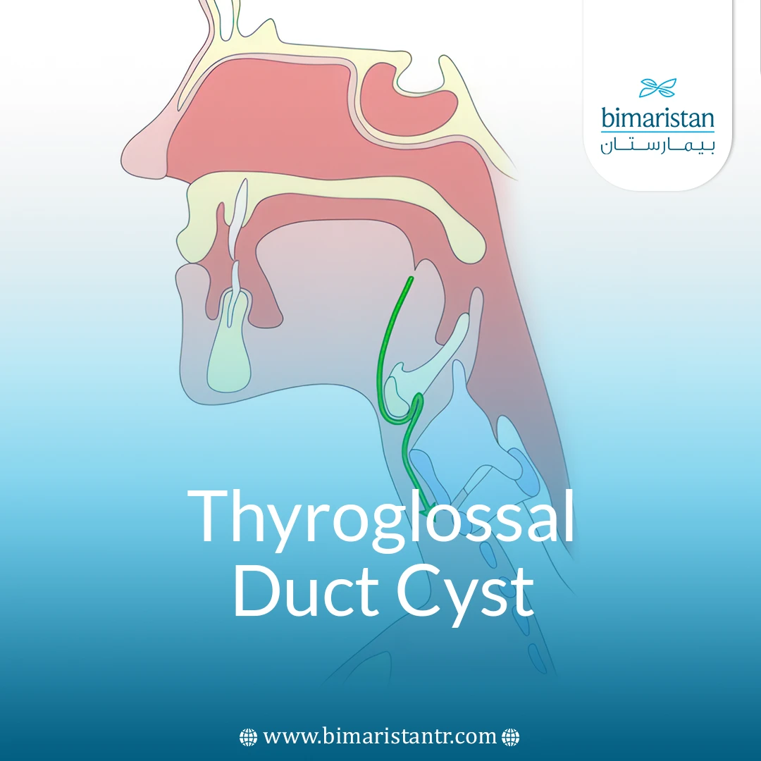 Thyroglossal Duct Cyst: What It Is & Surgical Removal Guide