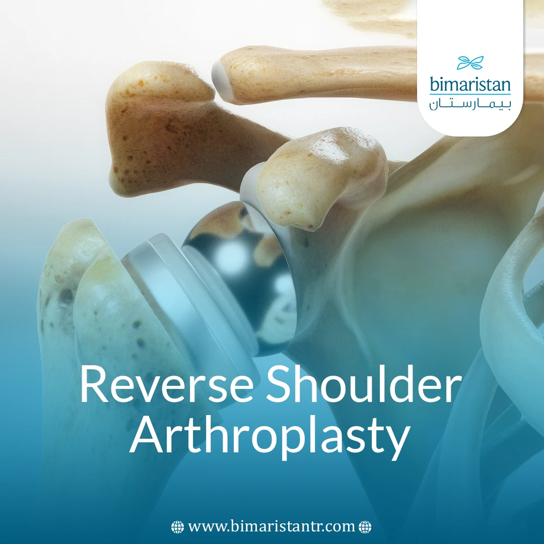 Reverse Shoulder Arthroplasty: Procedure and Recovery