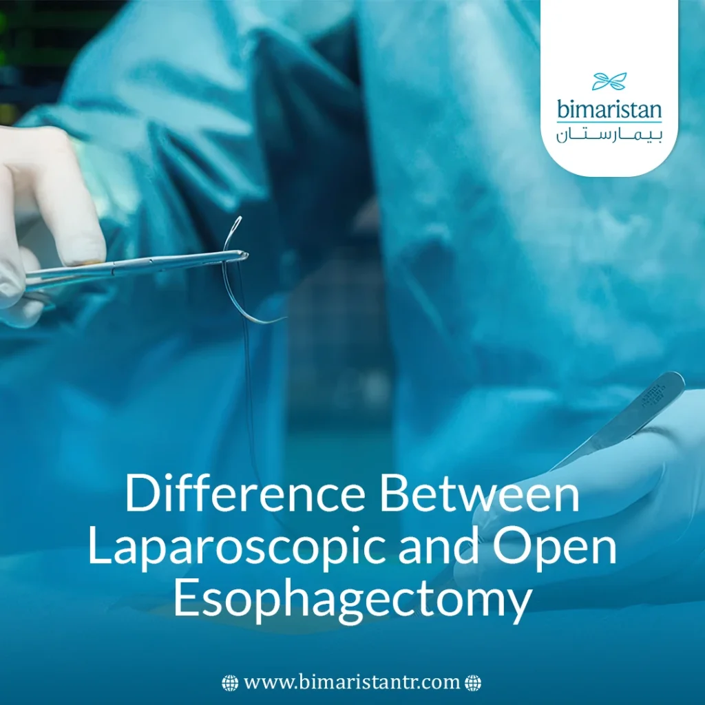 Difference Between Laparoscopic and Open Esophagectomy