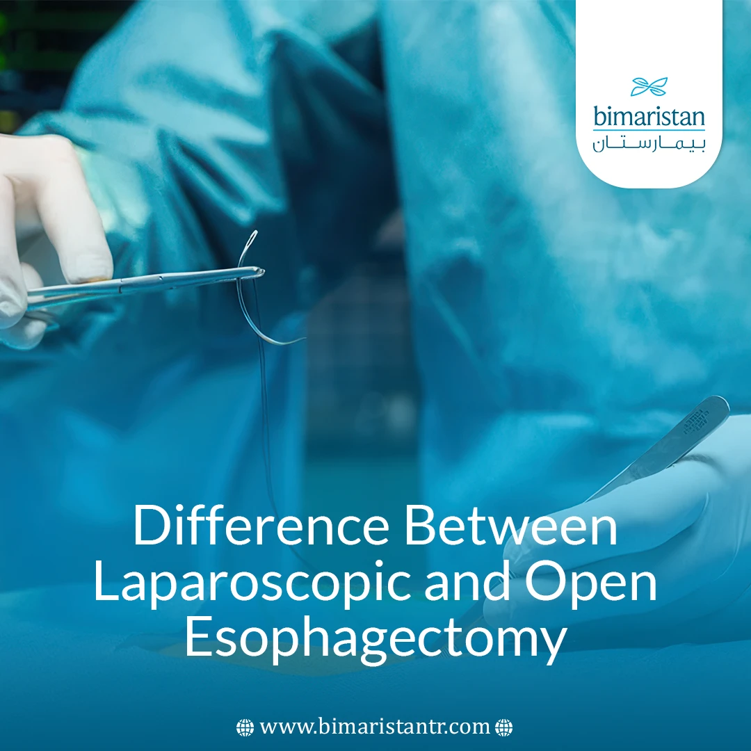 Difference Between Laparoscopic and Open Esophagectomy