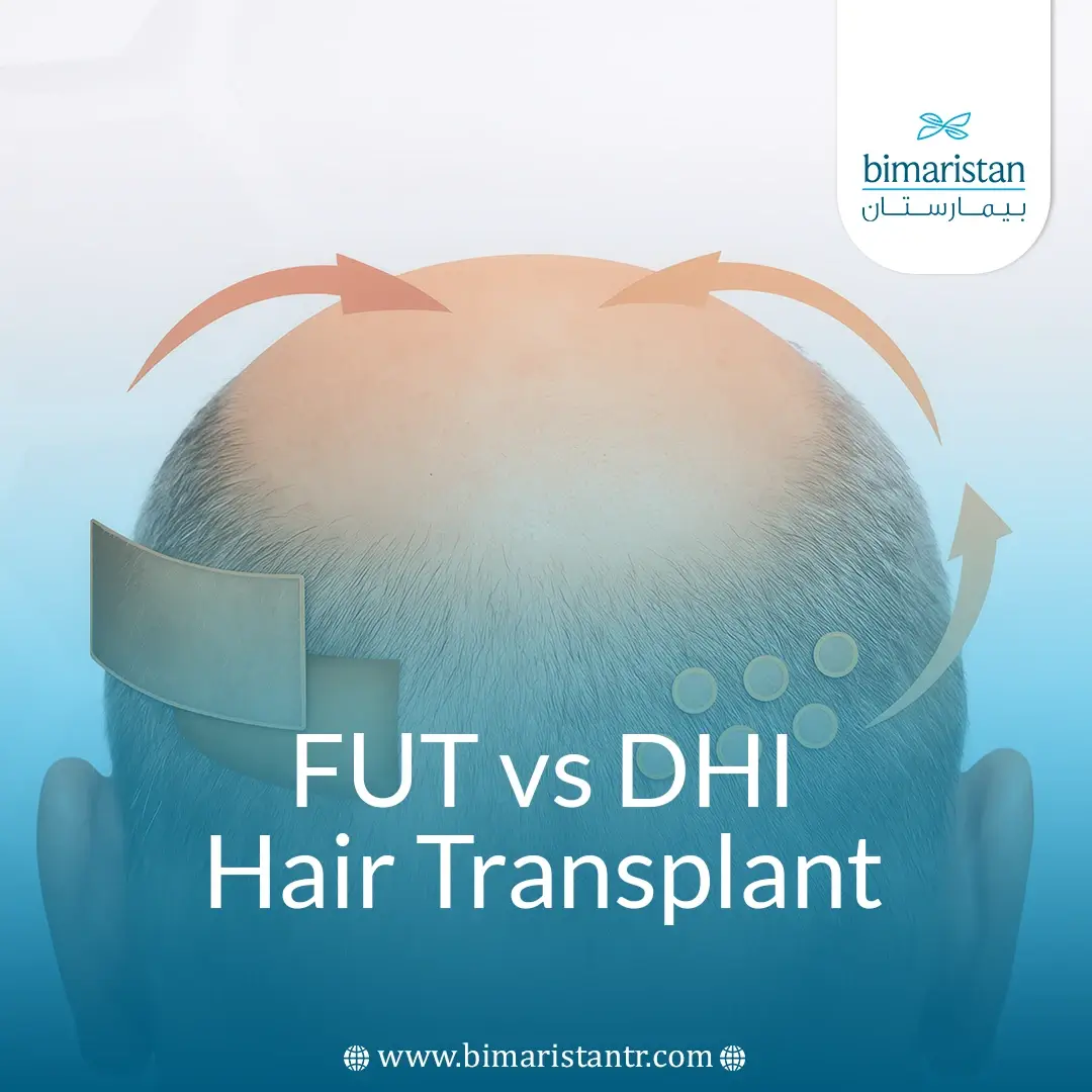 FUT vs DHI Hair Transplant: Which is Better for You?