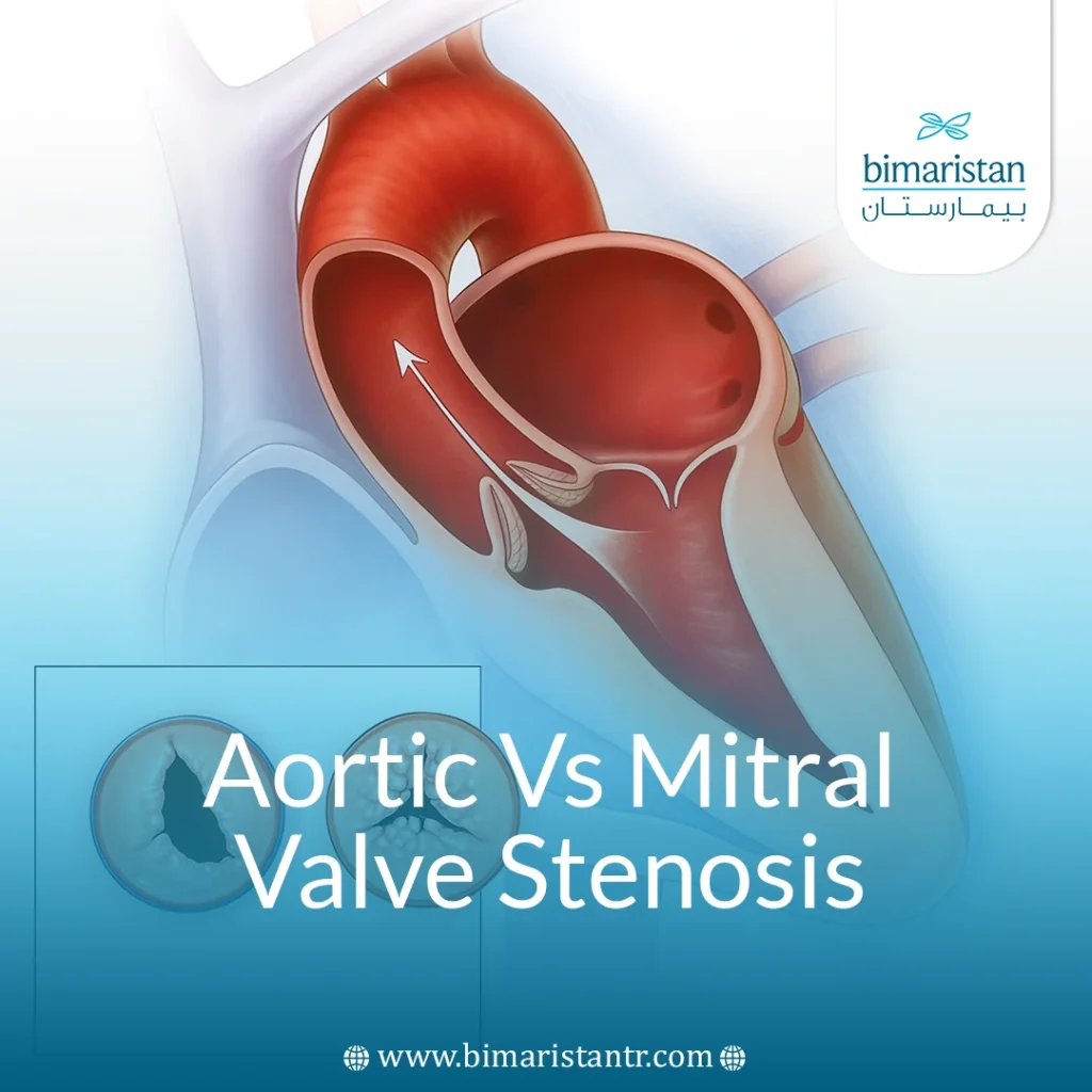Aortic vs Mitral Valve Stenosis: Symptoms and Key Treatments